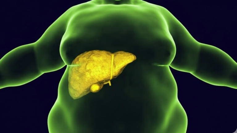 Fatty liver is a metabolic disease, not an alcohol problem, doctors warn