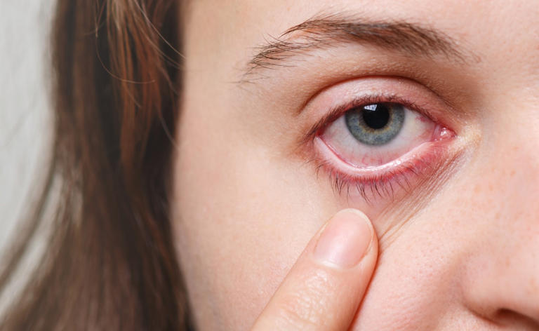 7 signs and symptoms of an eye infection