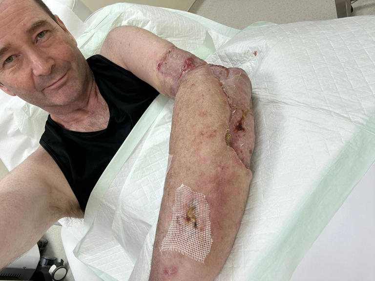 Dubai man has arm rebuilt after flesh-eating bacteria devour skin and ...