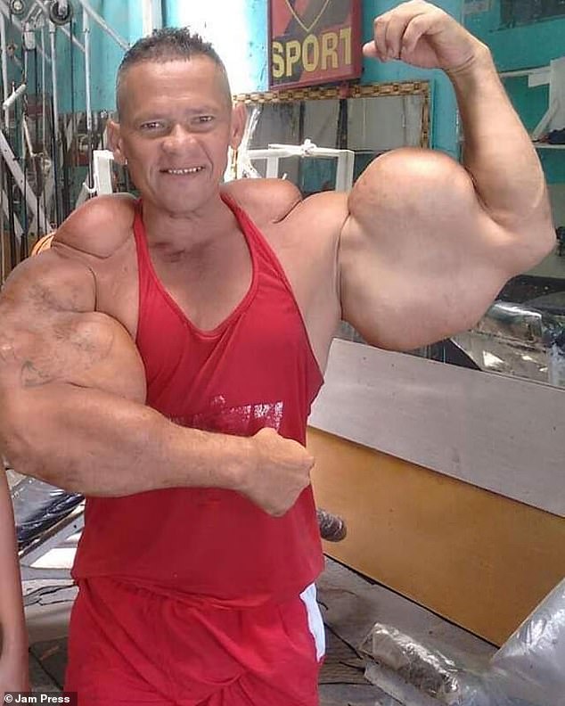 'Brazilian Popeye' bodybuilder famed for injecting alcohol and oil into ...