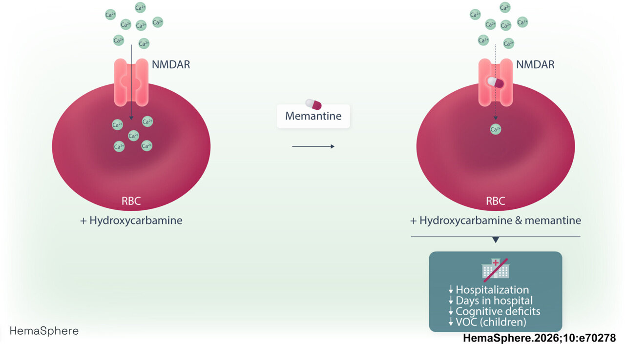 Safe, low-cost Alzheimer's drug demonstrates efficacy against sickle ...