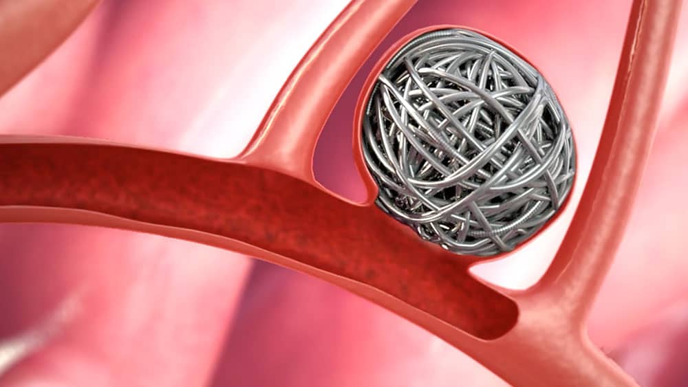 Lightning flashes as Boston Scientific takes over Penumbra for $14.5 ...