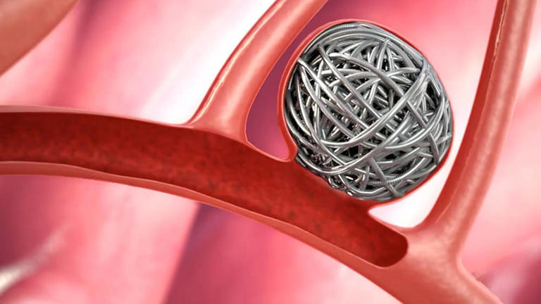 Lightning flashes as Boston Scientific takes over Penumbra for $14.5 ...