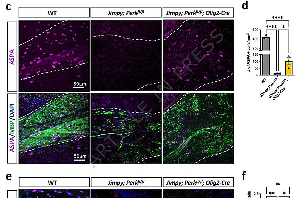 New drug approach targets stress response in rare brain disorder PMD
