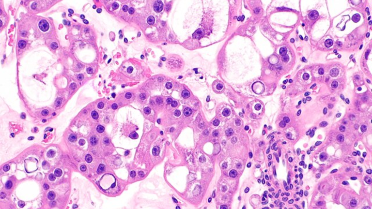 Food & Drug Experts Say New Kidney Cell Therapy Could Transform Chronic ...