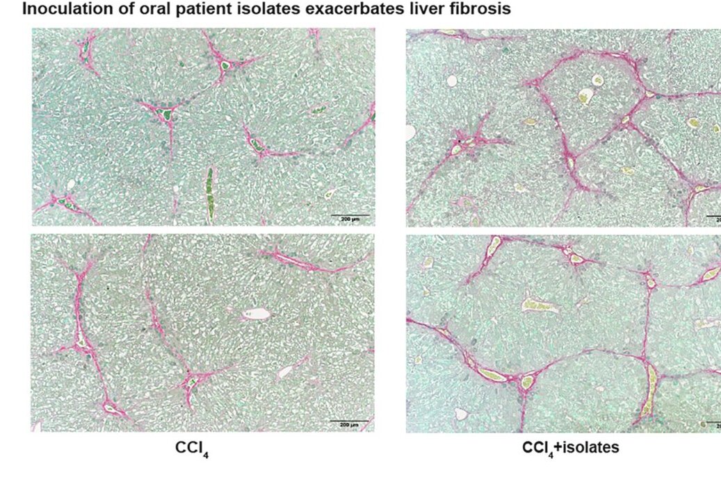 Altered microbiome: Oral bacteria play a role in chronic liver disease ...