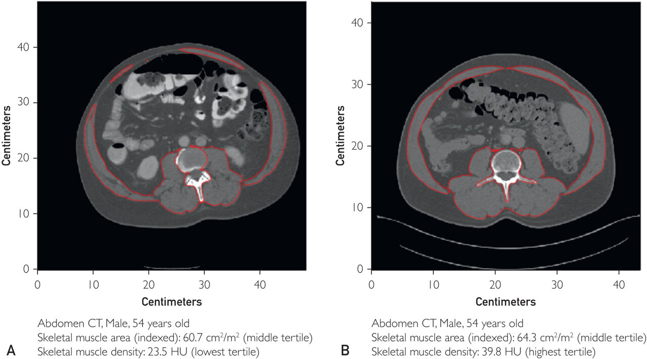 AI links abdominal muscle density in midlife to higher fall risk
