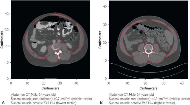 AI links abdominal muscle density in midlife to higher fall risk