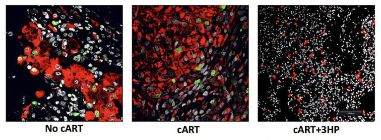 Standard TB and HIV treatments leave lung immune system impaired, study ...