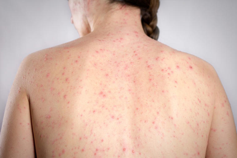 The hidden measles complication that can kill you years later — as ...