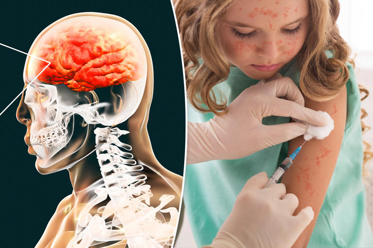 The hidden measles complication that can kill you years later — as ...