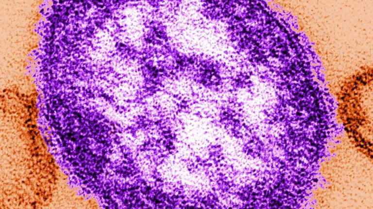 Measles outbreak declared in Snohomish County as 3 local children test ...
