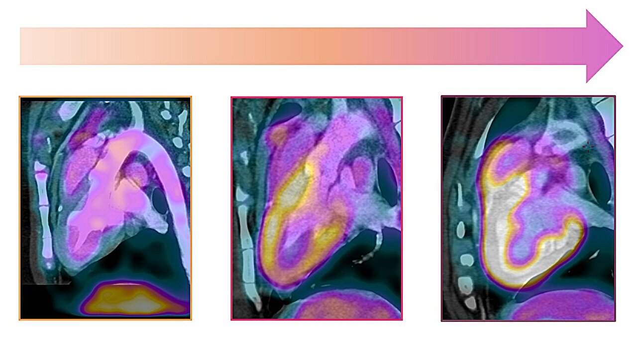 Study finds high blood pressure primes heart for damage from cancer drugs