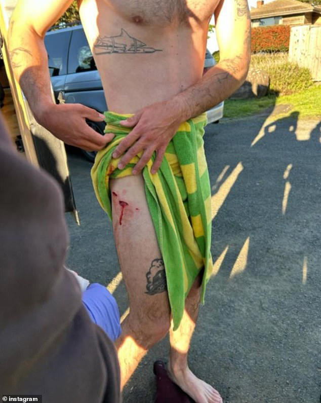 Surfer describes perilous shark bite as his board is snapped in half ...