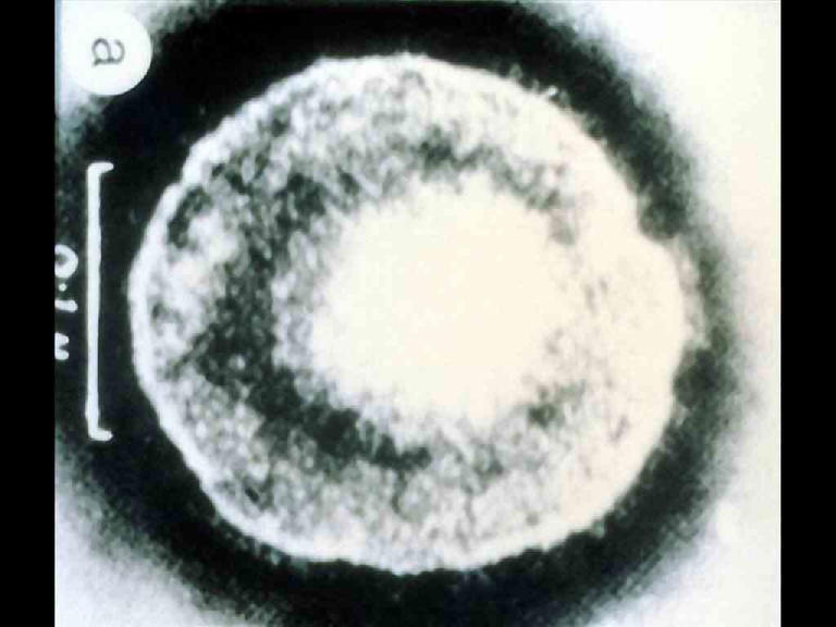 Encefalite da virus dell’herpes simplex, la mossa di Alfasigma