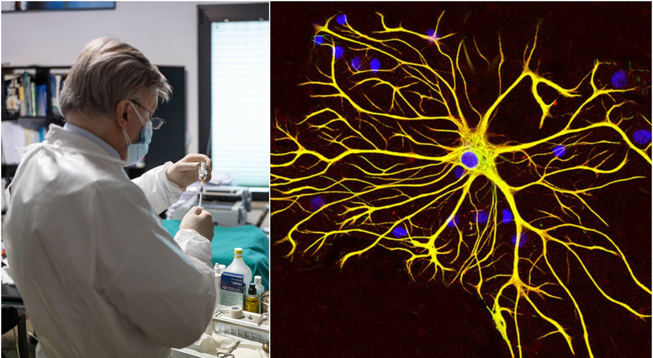 Sclerosi multipla, individuate le cause all'origine della malattia: è ...