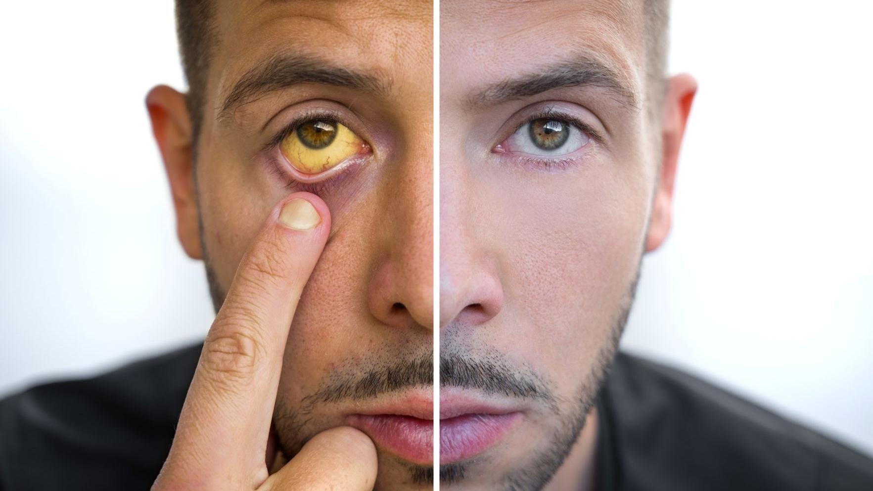 Warnsignale für eine kranke Leber, die Sie nicht ignorieren sollten