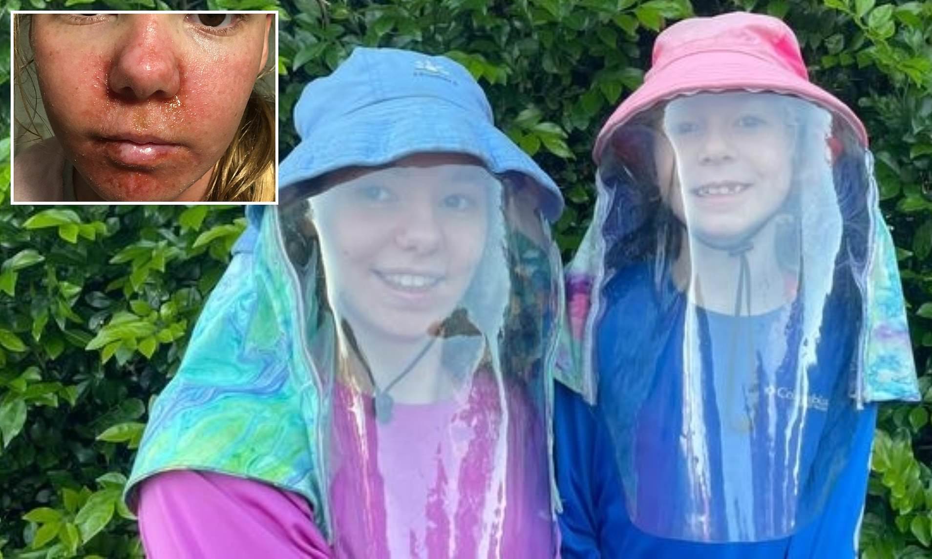 Sisters battling rare skin condition forced to hide under UV-safe ...