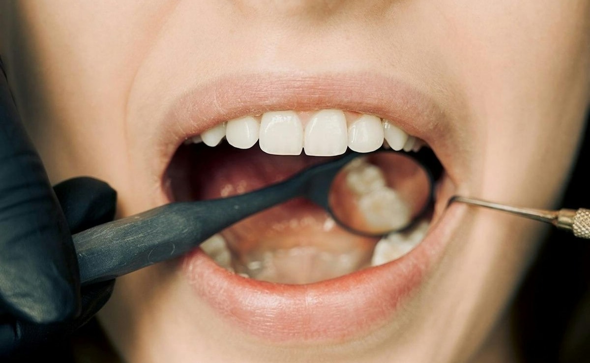 Your mouth bacteria can predict risk of chronic liver disease: Study