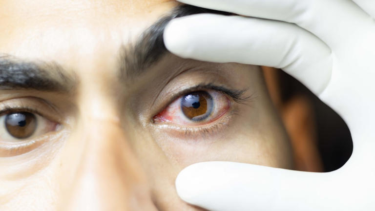 Eye infections surge during winters? What ophthalmologists say