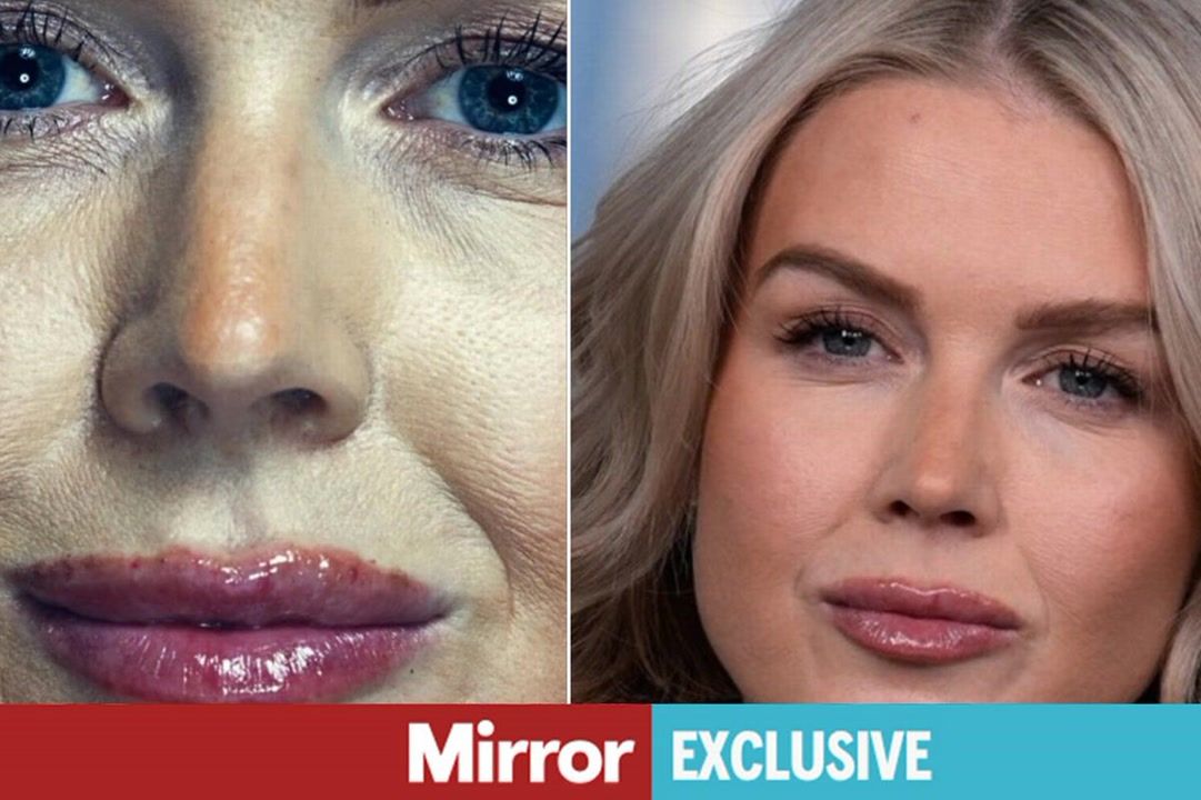 Expert cautions against lip fillers during pregnancy period