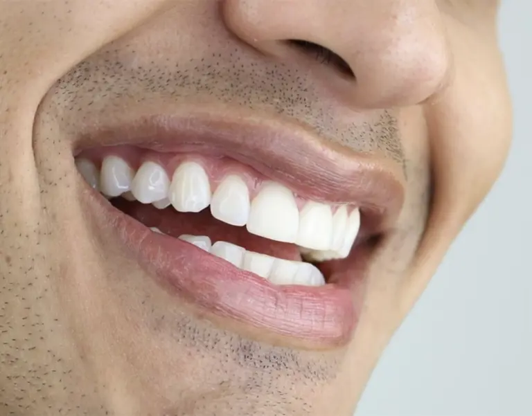 What to expect before, during, and after professional teeth whitening