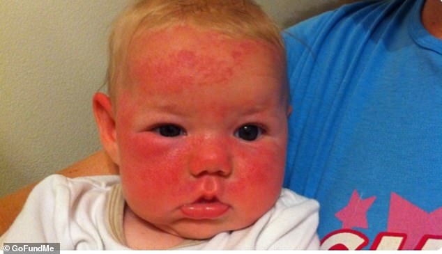 Sisters battling rare skin condition forced to hide under UV-safe ...