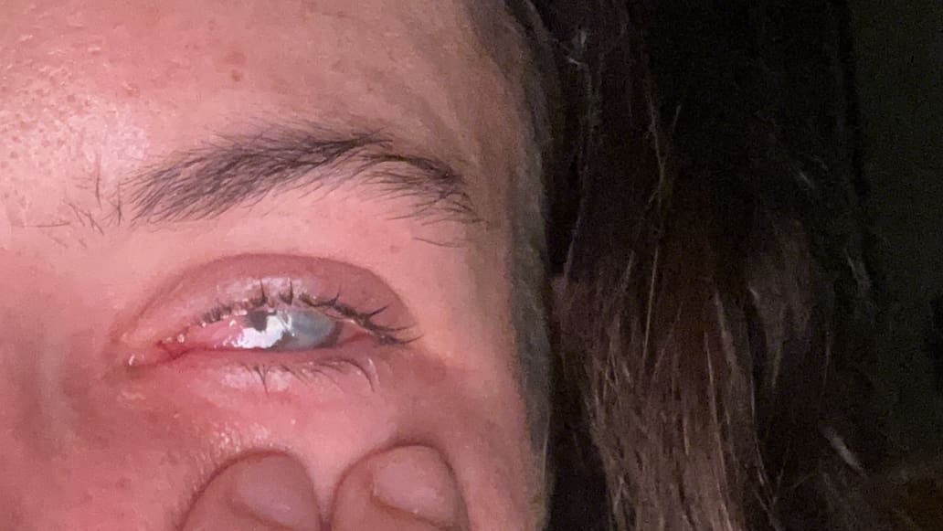 Von Traumreise zu Horrortrip: Frau hatte plötzlich Parasiten im Auge ...