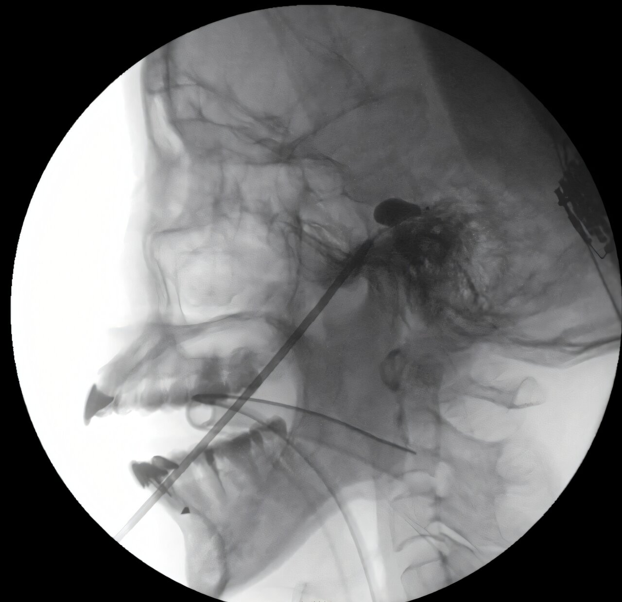 Percutaneous balloon compression developed for managing orofacial pain