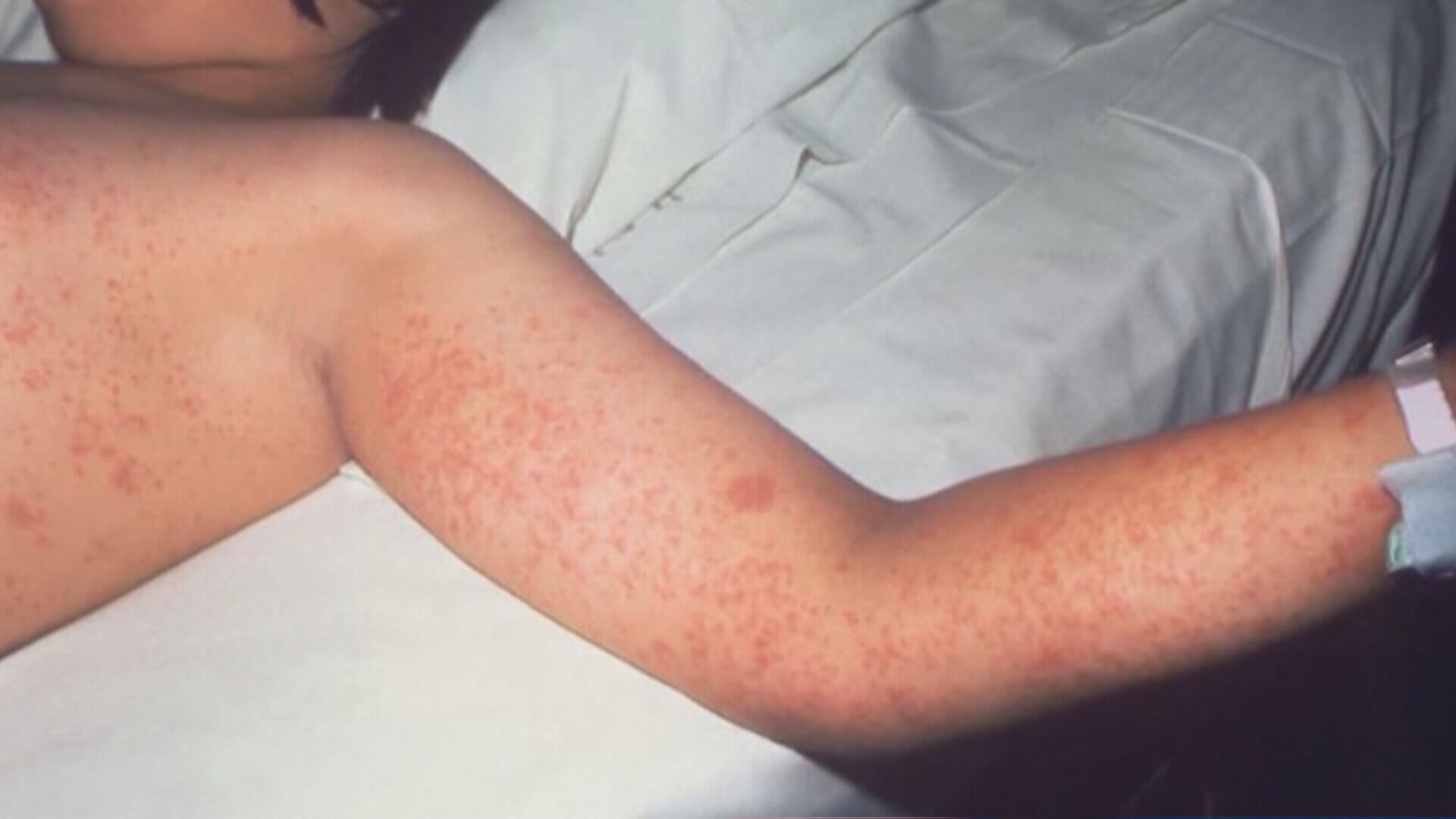 Health matters: Doctors warn about new uptick in measles cases in Alberta