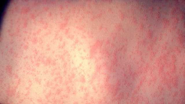 Cabarrus County health officials confirm two new measles cases