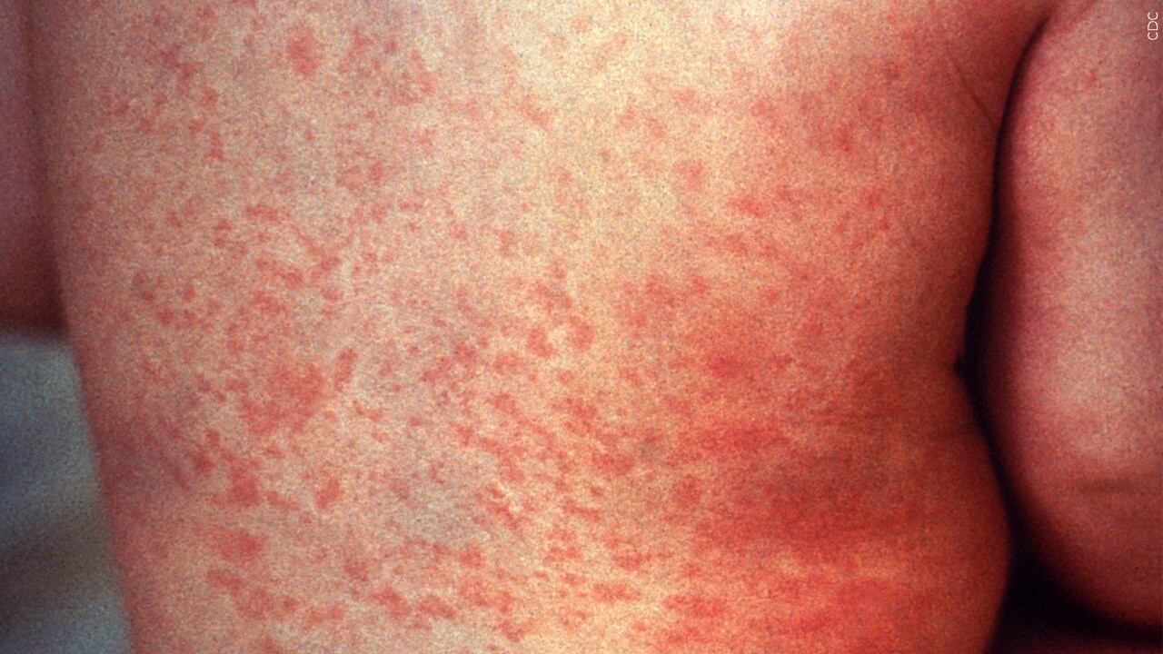 Person in federal custody in Pinal County has the measles, officials say