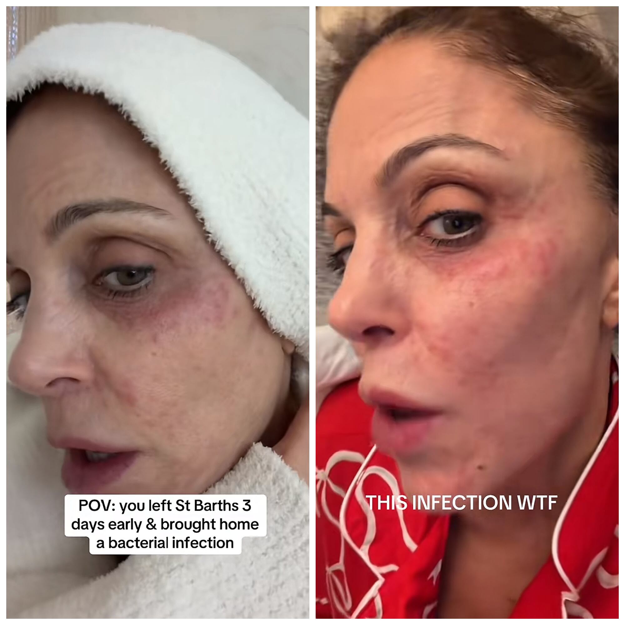 'Real Housewives' star gives update on gross infection from luxury getaway