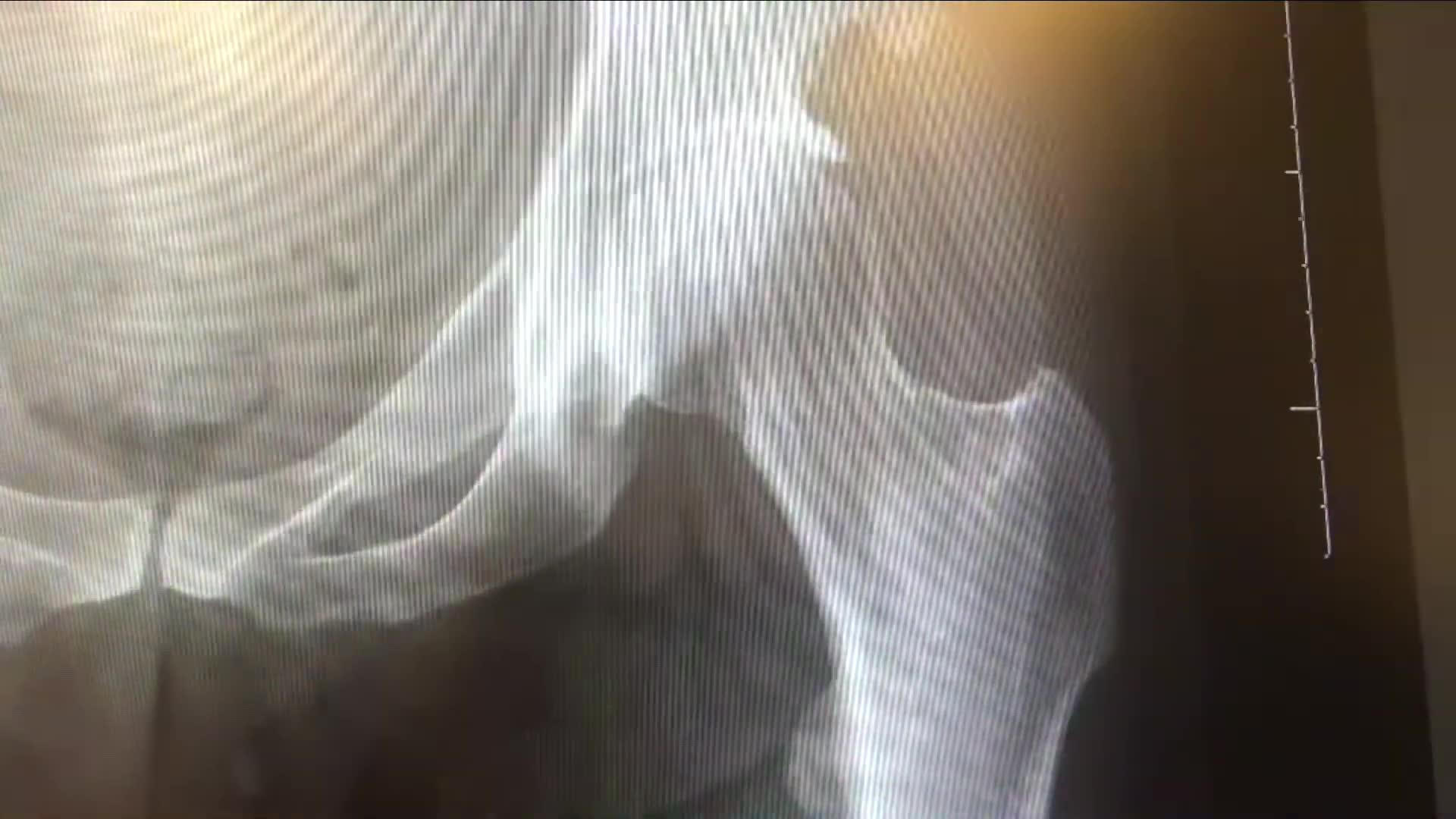 Early detection of pediatric hip problems