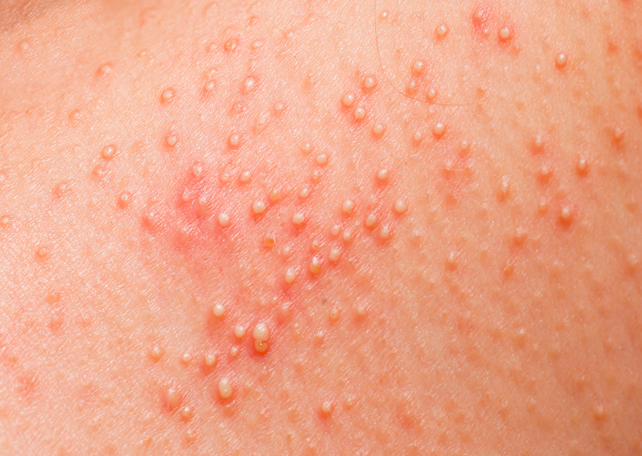 Heat rash explained in 8 photos -- how to spot it and what to do about it