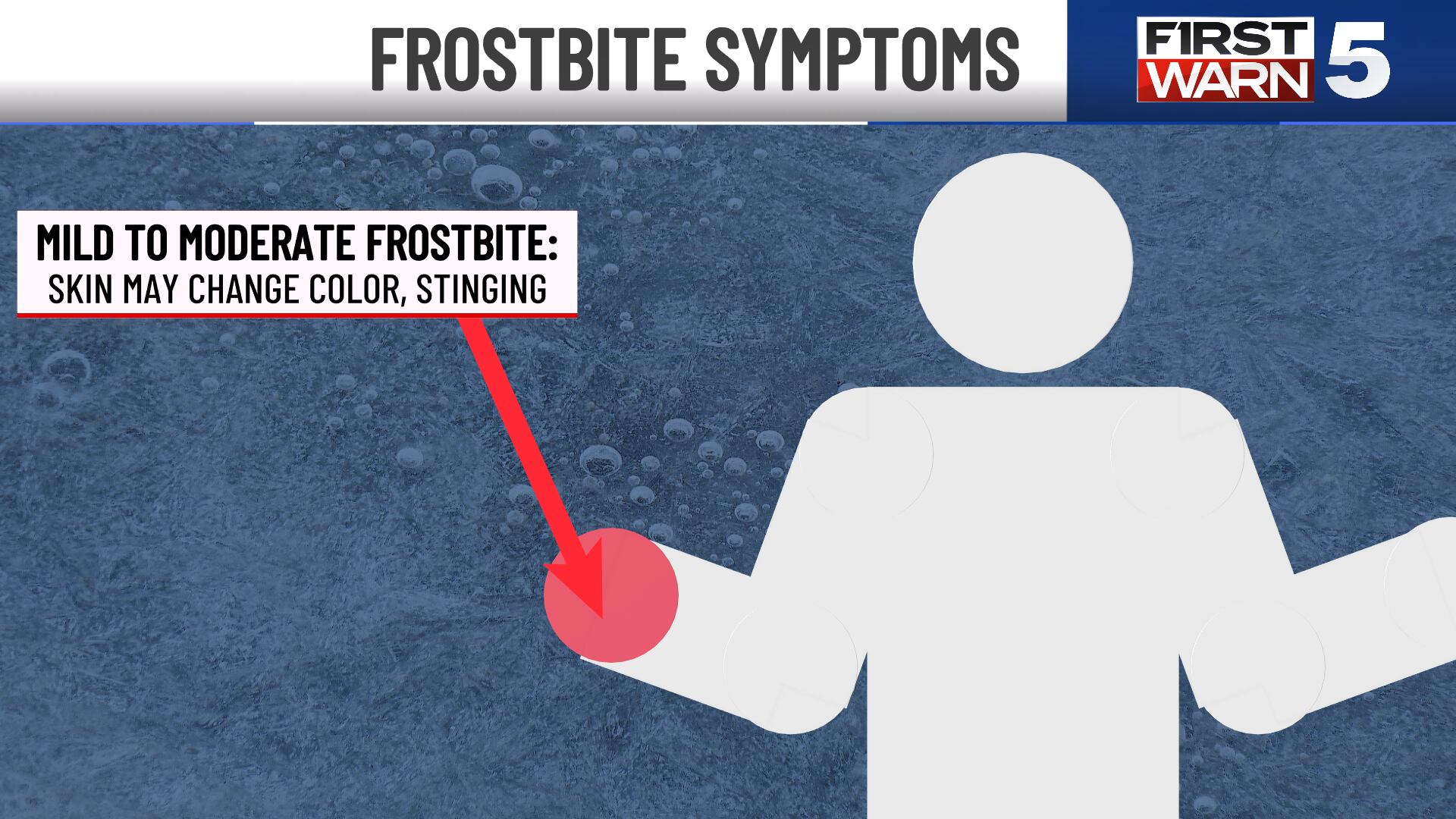 Frostbite concerns arise during weekend cold snap: How to keep yourself ...