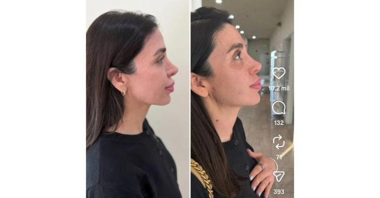 Emma Coronel se hizo un nuevo procedimiento estético, así luce ahora la ...