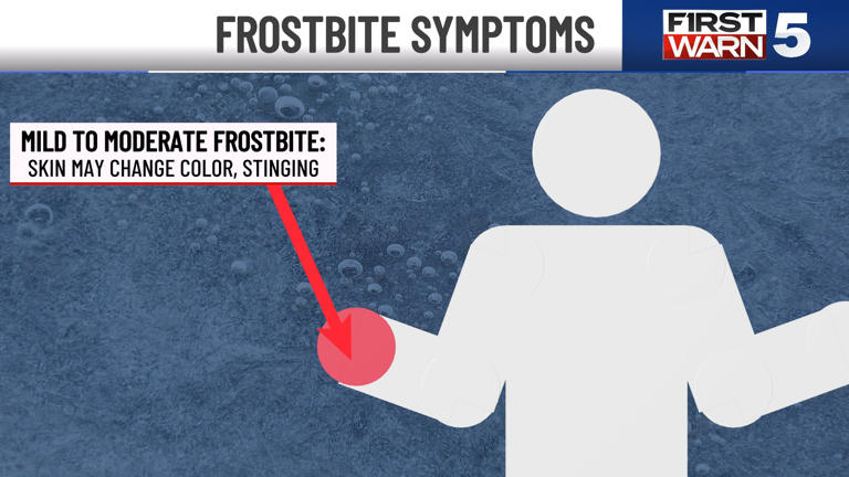 Frostbite concerns arise during cold snap: How to keep yourself safe