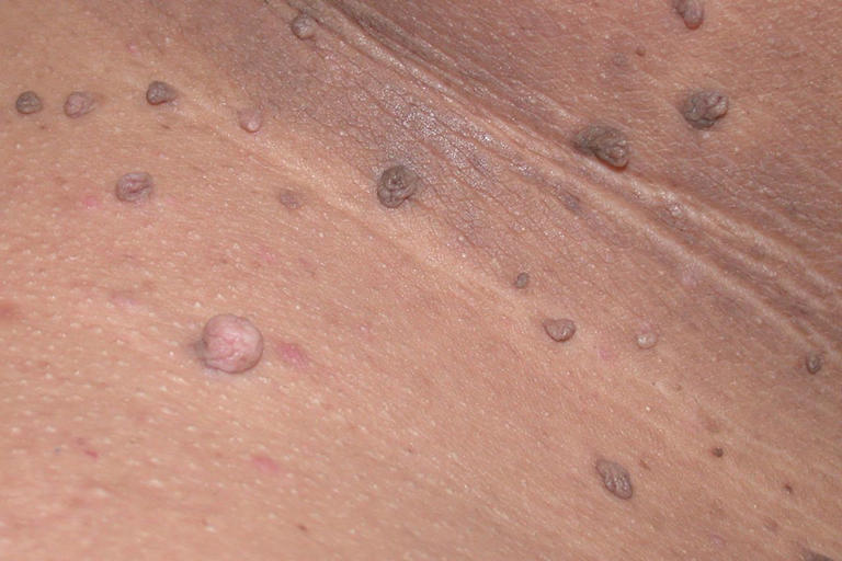 Is that a skin tag in your groin? What to know