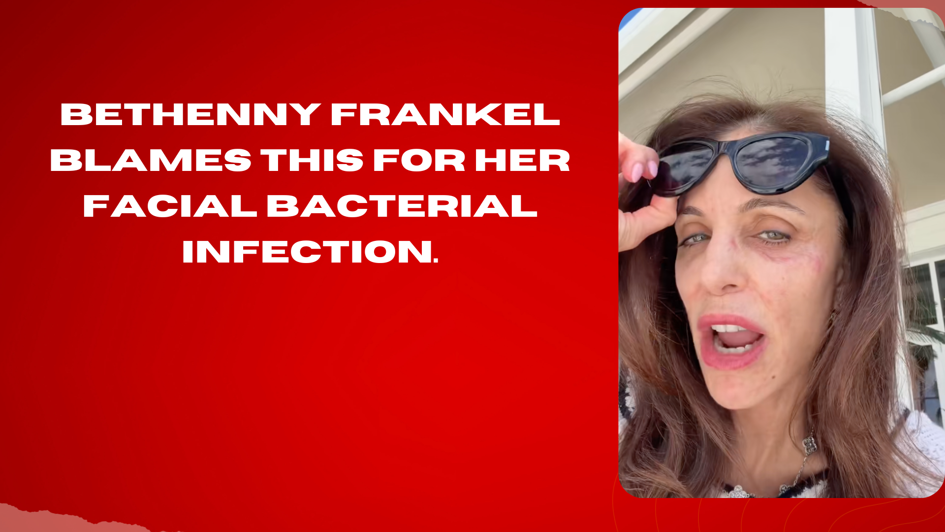 Bethenny Frankel blames this for her facial bacterial infection