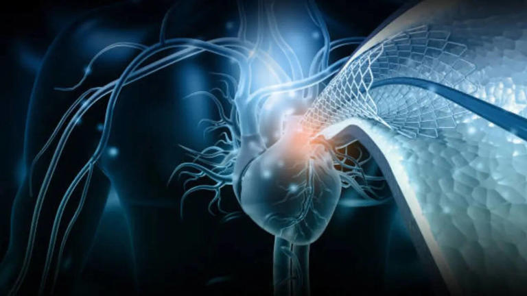 What is aortic stenosis, a normal ageing symptom that signals a ...