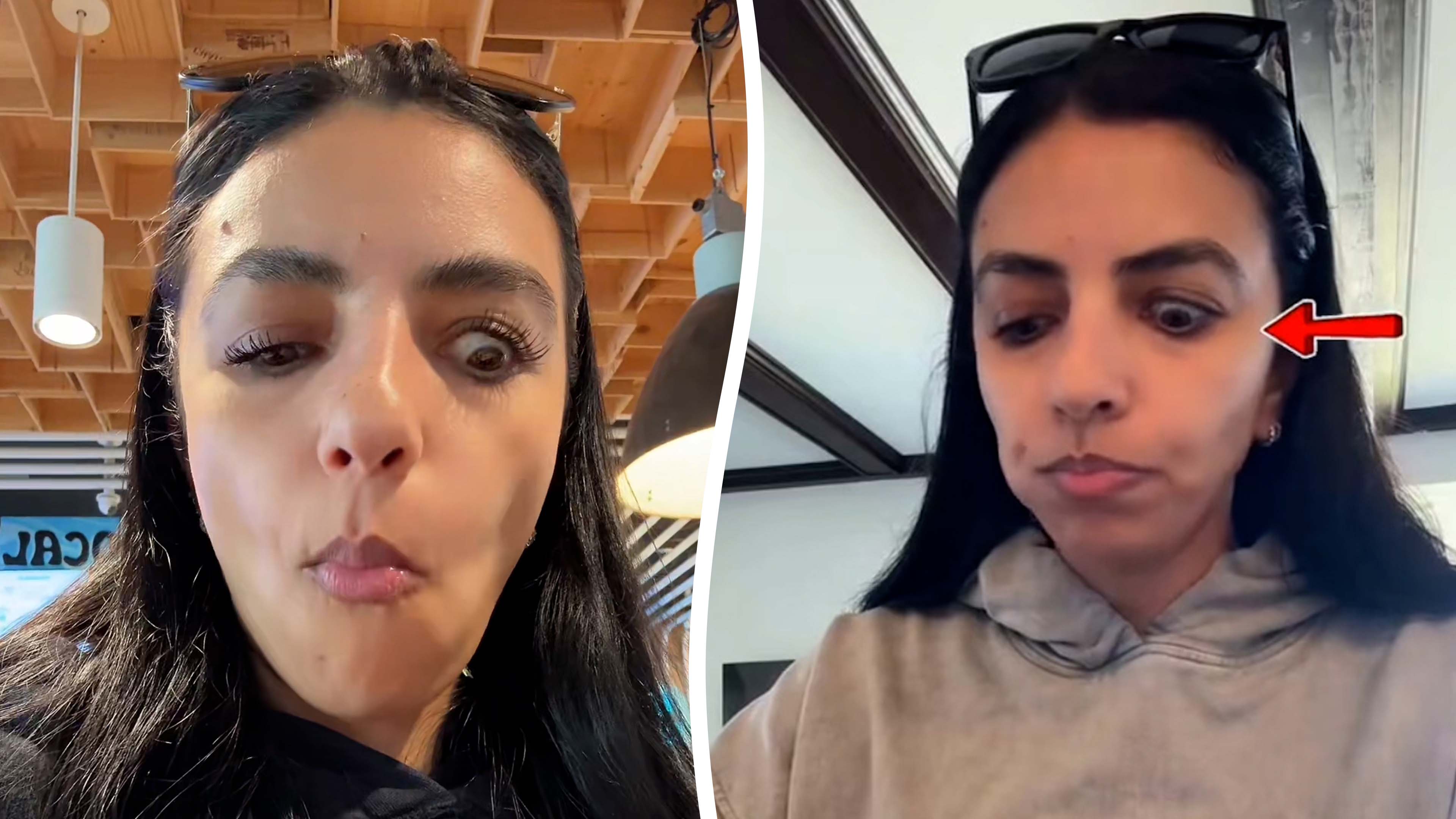 Rare syndrome makes woman’s eye bulge when she chews food - and she ...
