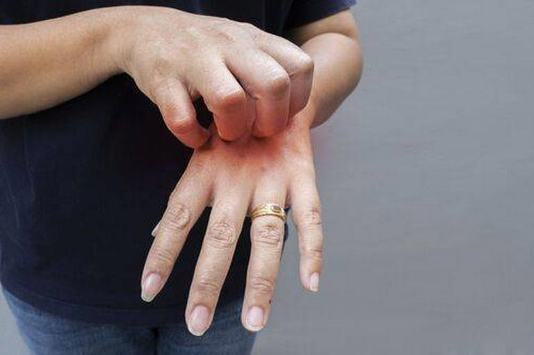 Allergy to cold weather that leaves painful red spots all over your body