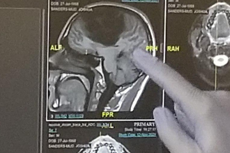 I had a seizure at 23—then surgeons removed a third of my brain