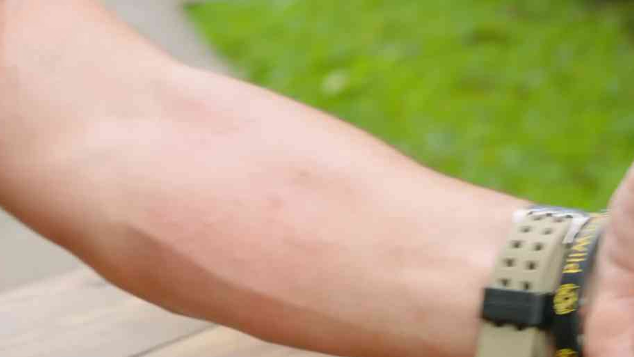 Stung by the gympie gympie: The world’s most painful plant