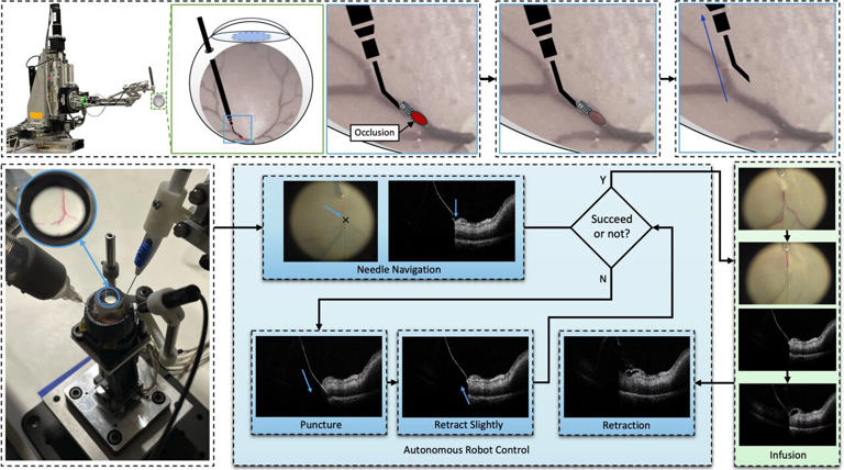 A new robotic system could perform delicate eye surgery
