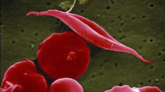 Maharashtra using tribal languages to spread awareness on sickle cell ...