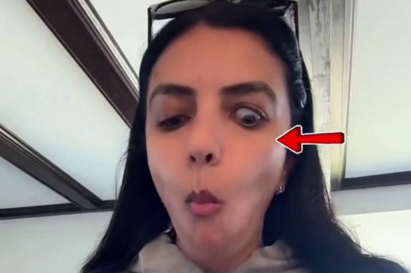 'My eye bulges every time I eat and it's a part of me I love'