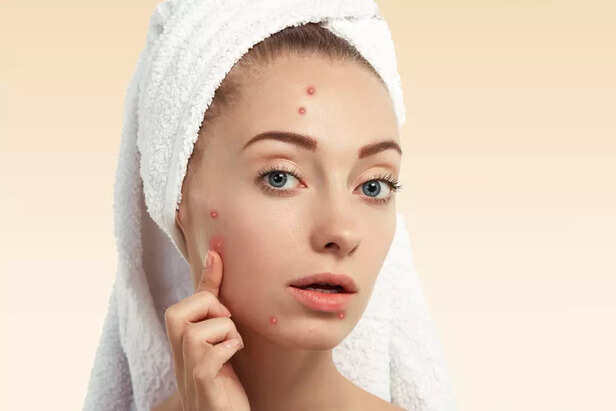 Pimples on the forehead? These habits might be the reason