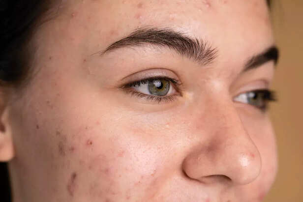 Pimples on the forehead? These habits might be the reason